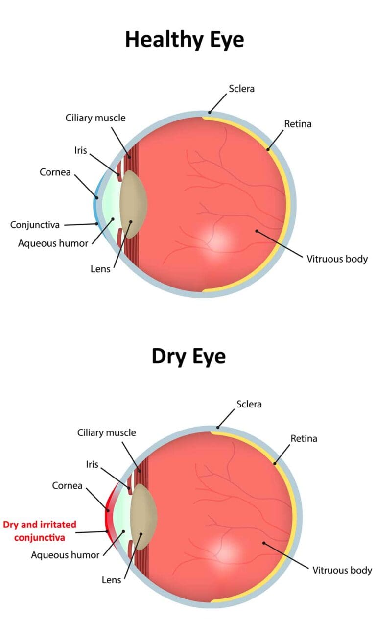 Can I Get LASIK After Cataract Surgery?